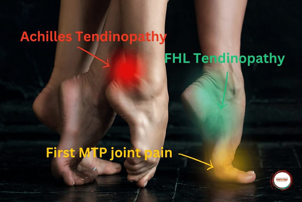 Preventing Tendonitis in Ballet Dancers: Understanding and Managing the ...