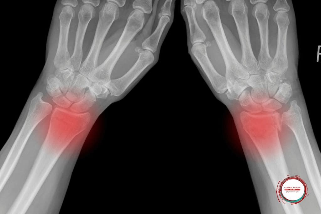 Navigating the Challenge of a Broken Wrist: Understanding Colles ...