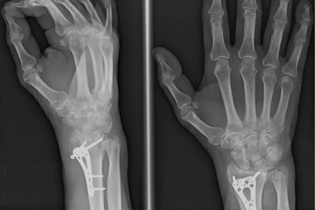 What Are the Most Common Types of Wrist and Hand Fractures? | Central ...