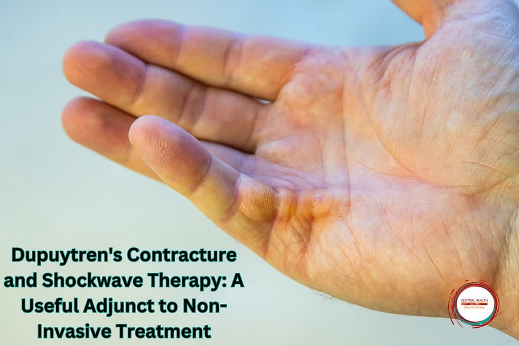 Dupuytren's Contracture and Shockwave Therapy: A Useful Adjunct to Non ...