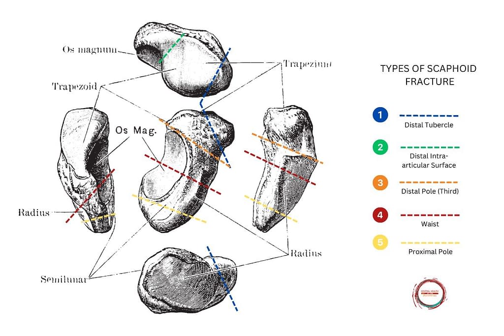 Understanding Scaphoid Fractures: A Comprehensive Guide to Diagnosis ...