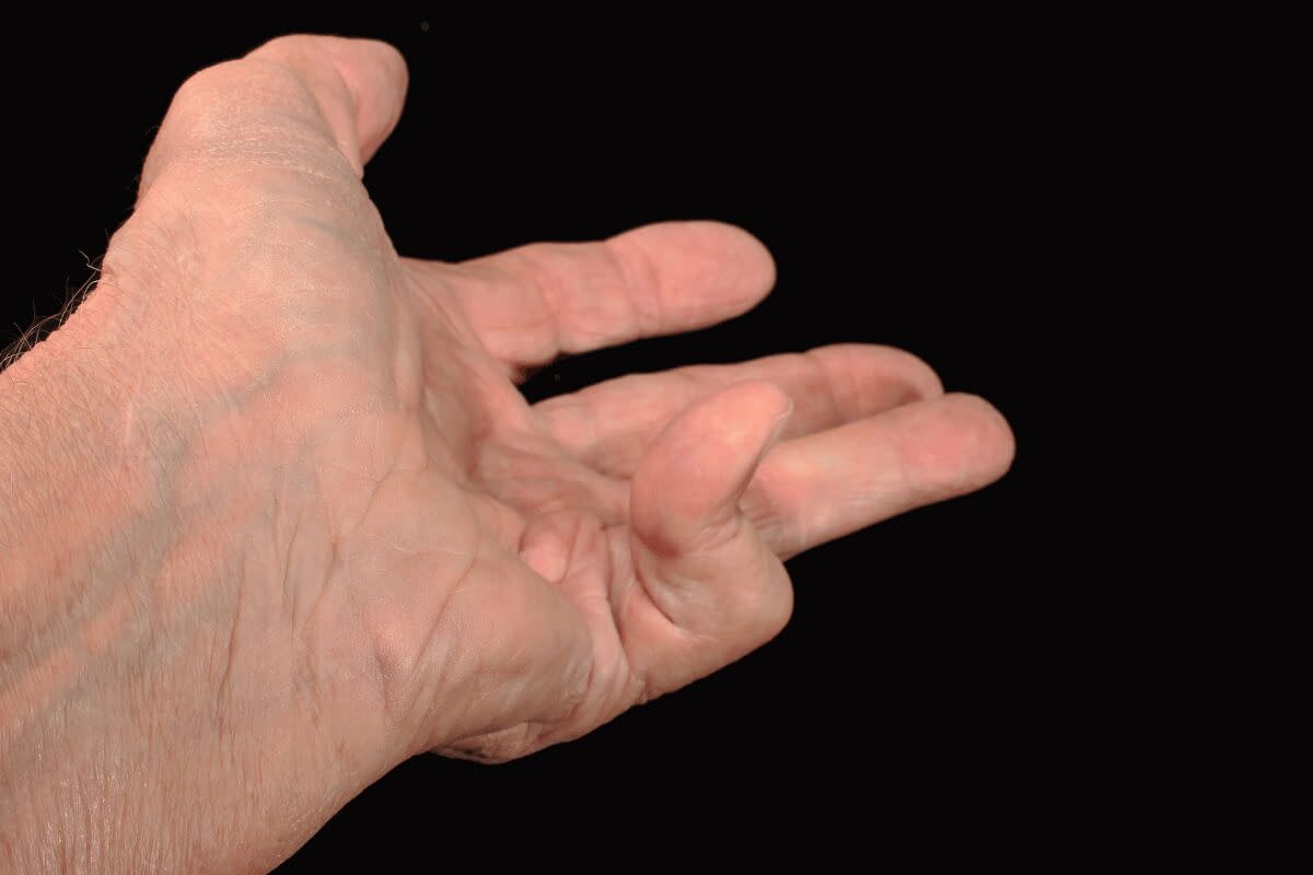 Understanding Dupuytren's Contracture: A Deep Dive into Symptoms ...