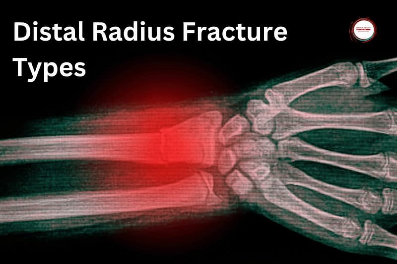 Navigating the Complex World of Distal Radius Fracture Types: What You ...