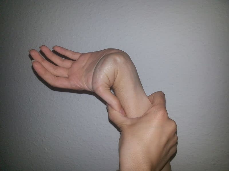 Hypermobility | Central Health Physiotherapy