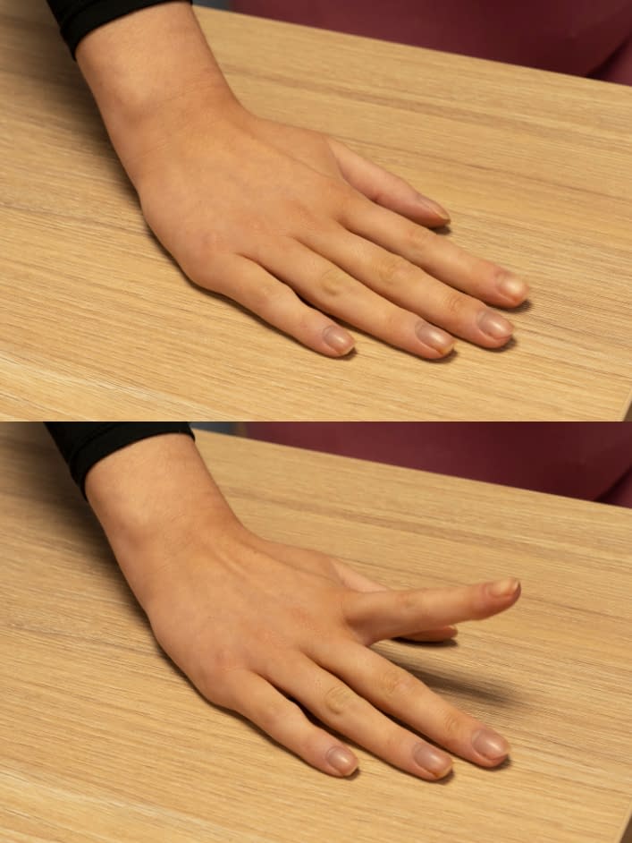 Triangular Fibrocartilage Complex (TFCC) Injury Advanced Exercise ...