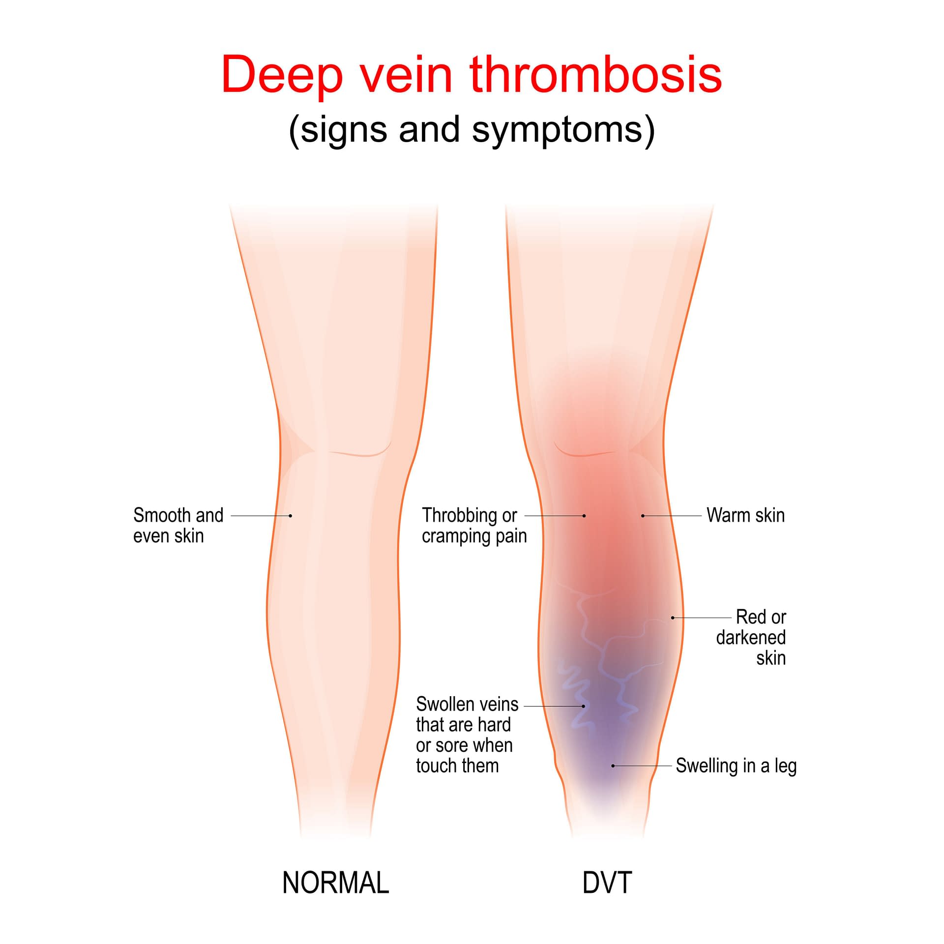 DVT Awareness Month - What is DVT? | Central Health Physiotherapy