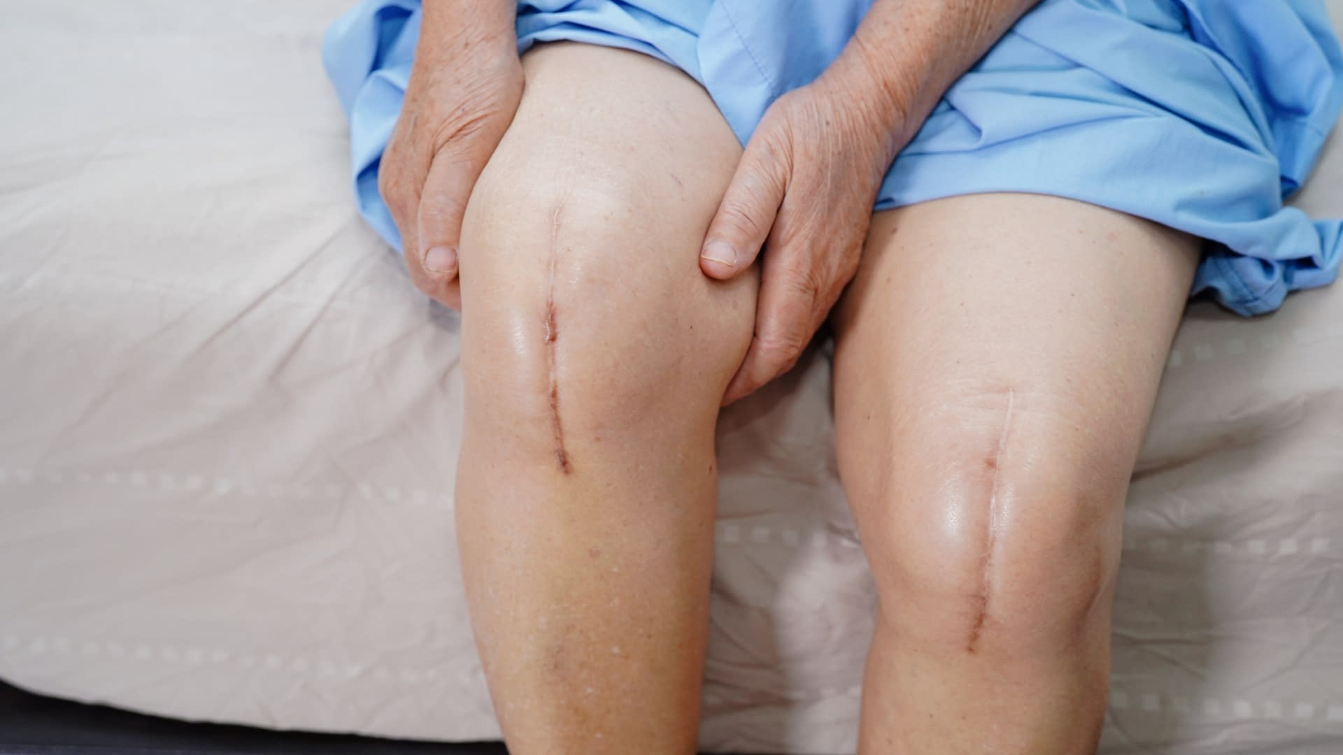 A guide to joint replacement: recovery, longevity and aftercare - Pure ...